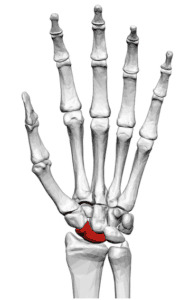 Preiser's Disease (AVN of the Scaphoid): a Leading Hand Surgeon From ...
