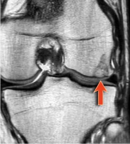 Knee AVN In a Lupus Patient Desires Knee Stem Cell Therapy with Dr. Lox ...