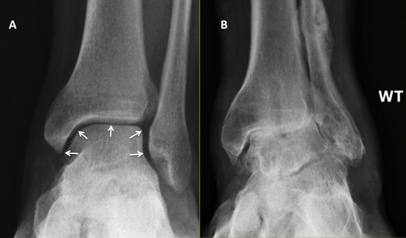 When An Ankle Joint Becomes Severely Worn Ankle Arthritis