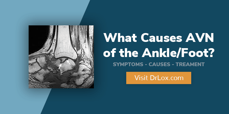 Avascular Necrosis (AVN) or Osteonecrosis of the Ankle/Foot