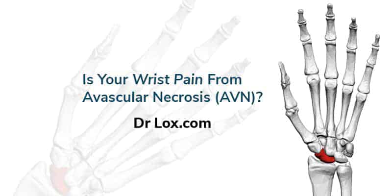 Wrist Avascular Necrosis (AVN) or Osteonecrosis Wrist Avascular Necrosis (AVN) or Osteonecrosis