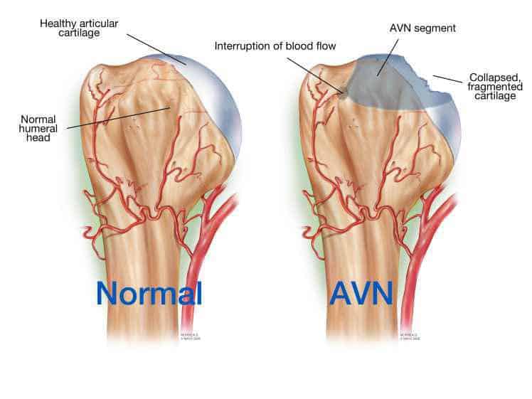 AVN Or Avascular Necrosis Explained - Dr. Dennis Lox Stem Cell Therapy AVN Or Avascular Necrosis Explained - Dr. Dennis Lox Stem Cell Therapy